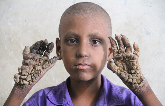 Epidermodysplasia Verruciformis 나무 남자 이전과 이후